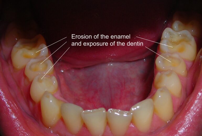 Causes of Tooth Erosion - Acharya Dental
